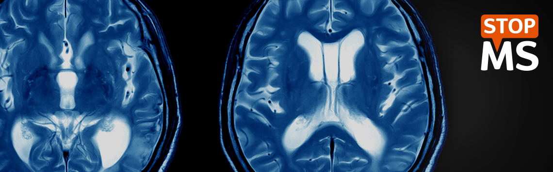 Stop MS | Multiple Sclerosis Society UK