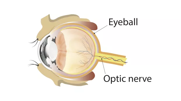 What causes MS eye problems | MS Society